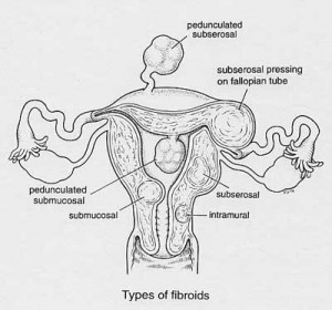 How Large Can Fibroids Grow